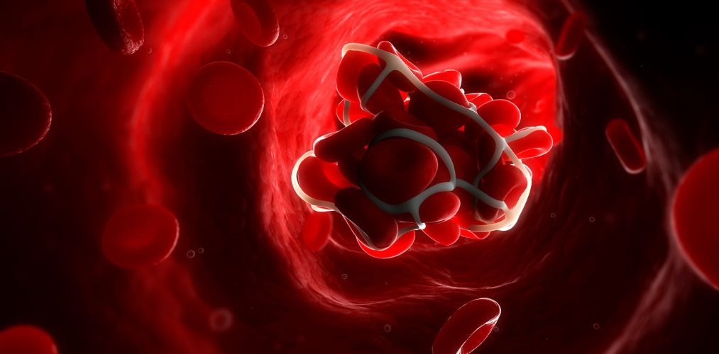 Saddle Pulmonary Embolism | A Serious Blood Clot